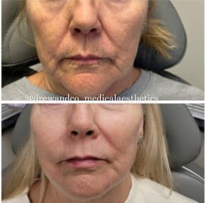 Full Face Facial Balancing & Harmonization | Drew & Co