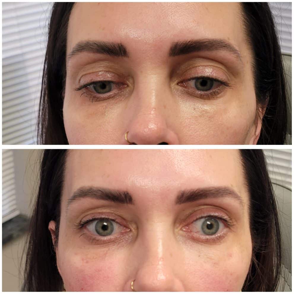 BioFiller | Drew & Co Medical Aesthetics | Kenosha, WI