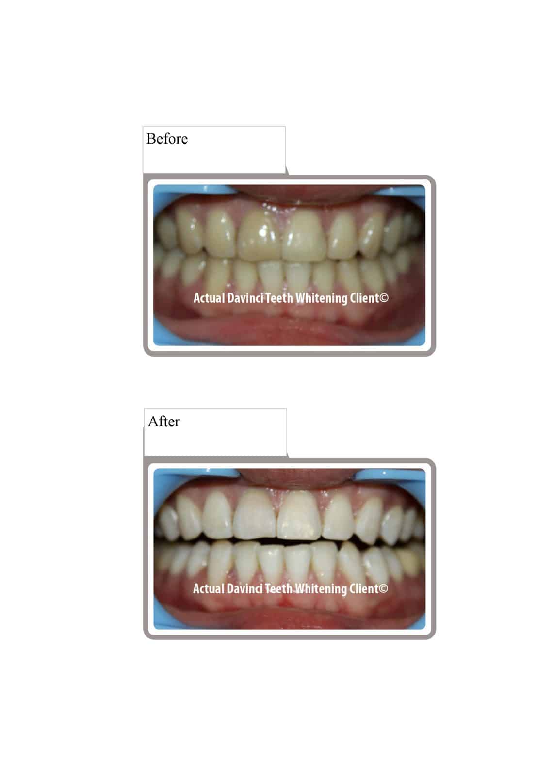 Teeth Whitening | Drew & Co Medical Aesthetics | Kenosha, WI